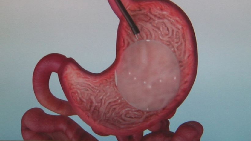 Orbera may help you loose weight | WCHS